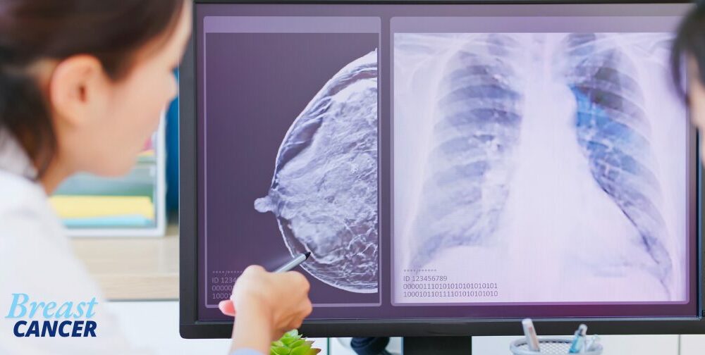 S6 Insights On"How AI Technology Is Revolutionizing Early Breast Cancer Detection And Treatment ...